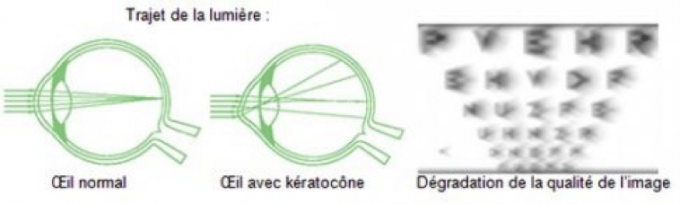 Kératocône: traitement, facteurs & risque