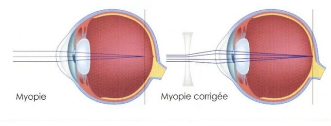 opération myopie Lyon, opération laser des yeux myopie: Ultravision ...